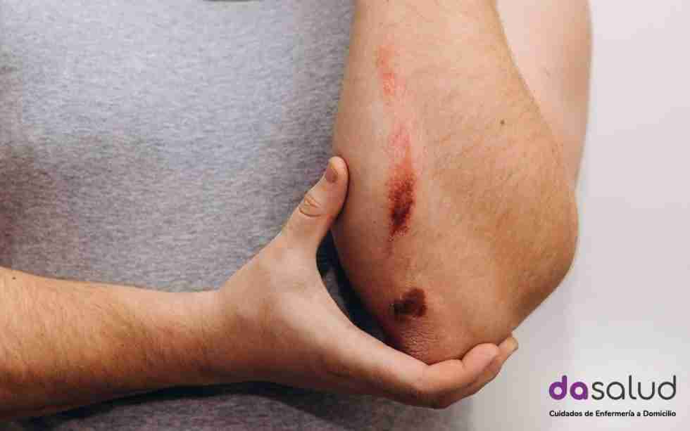 ¿Qué hacer con una costra infectada? - Cuidados sanitarios a domicilio ...